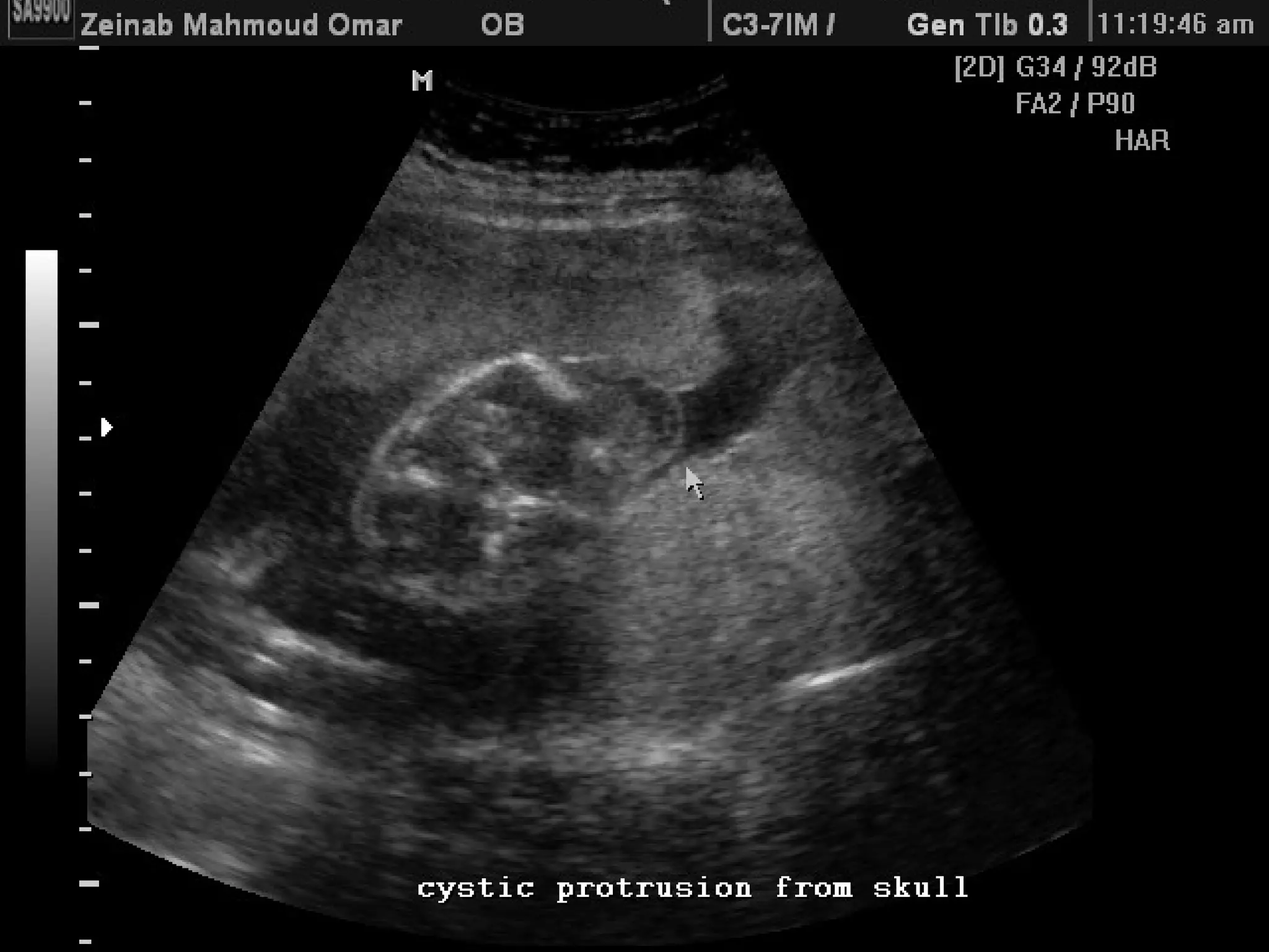 Routine fetal anatomy scan at 18-23 weeks | PPT