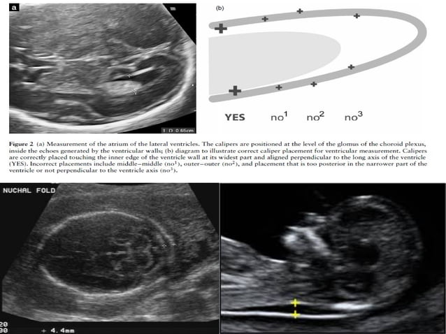 Routine fetal anatomy scan at 18-23 weeks | PPT | Pregnancy ...