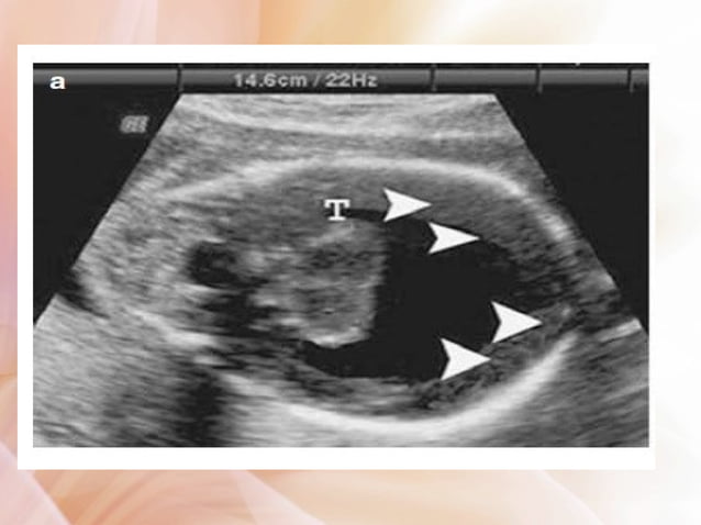 Routine fetal anatomy scan at 18-23 weeks | PPT | Pregnancy ...