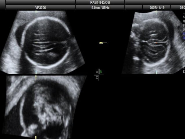 Routine fetal anatomy scan at 18-23 weeks | PPT | Pregnancy ...