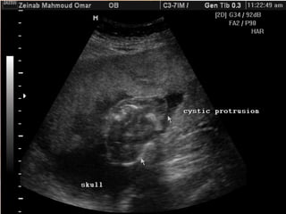 Routine fetal anatomy scan at 18-23 weeks | PPT