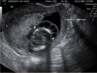 Routine fetal anatomy scan at 18-23 weeks | PPT