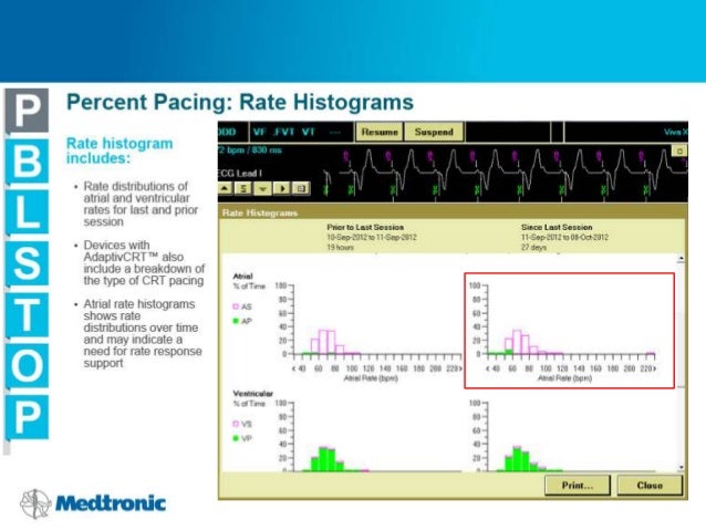 Routine Follow-Up of CRT Patients (ECG, Device Stored Information & R…