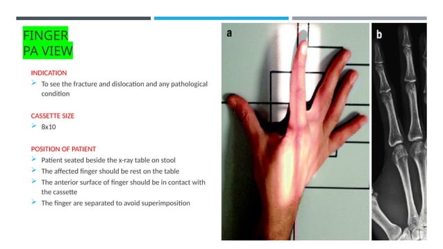 ROUTINE PROJECTIONS FOR FINGERS ppt.pptx | Death, Injury, or Military Conflict | Sensitive Topics