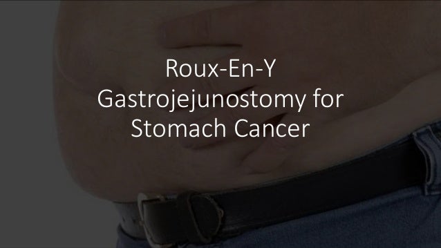 Roux-En-Y Gastrojejunostomy for Stomach Cancer | PPTX