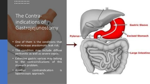Roux-En-Y Gastrojejunostomy for Stomach Cancer | PPT