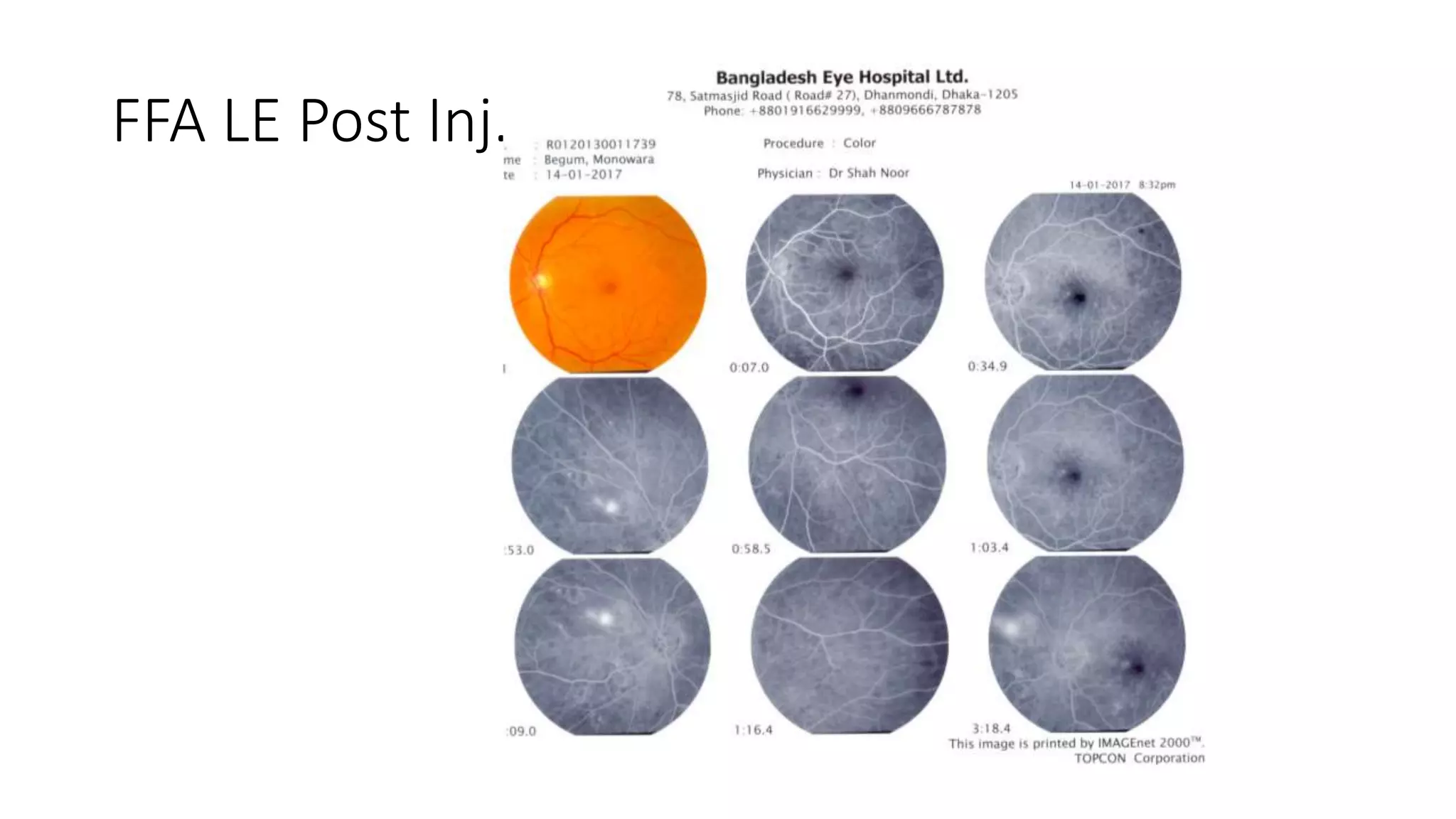Refractory Diabetic Macular Edema - A Case Report | PPTX