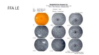 Refractory Diabetic Macular Edema - A Case Report | PPTX