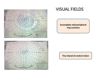 Retinitis pigmentosa and its allied diseases | PPTX