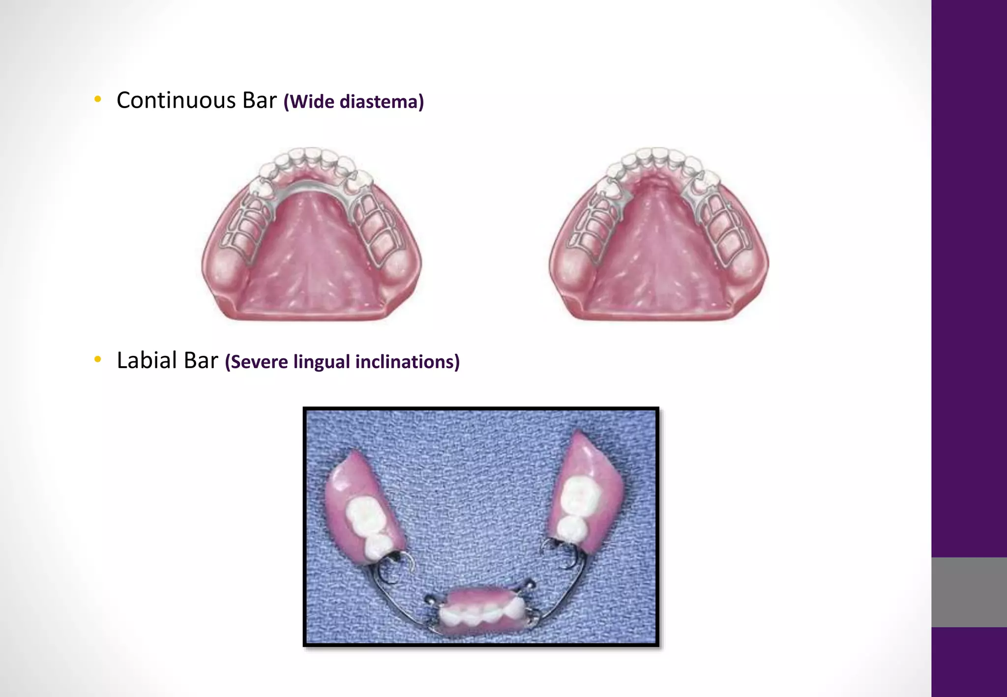 Removable partial denture | PPTX