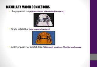 Removable partial denture | PPTX