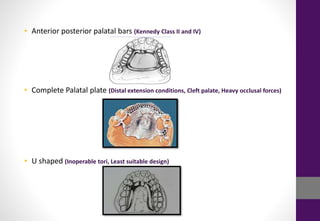 Removable partial denture | PPTX