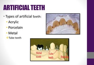 Removable partial denture | PPTX