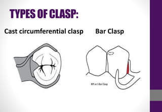Removable partial denture | PPT