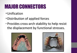 Removable Partial Denture Parts