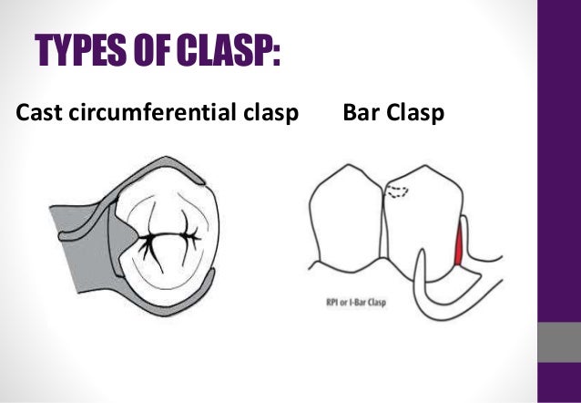 Removable partial denture
