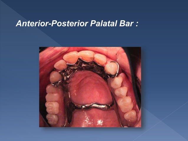 RPD Major Connectors | PPSX | Dental Health | Diseases and Conditions