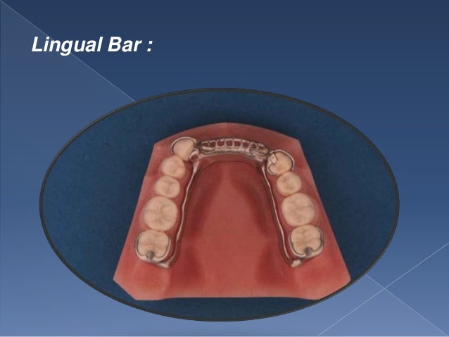 RPD Major Connectors