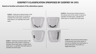 Classification of partially edentulous arches | PPTX