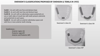 Classification of partially edentulous arches | PPTX