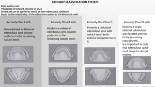Classification of partially edentulous arches | PPTX
