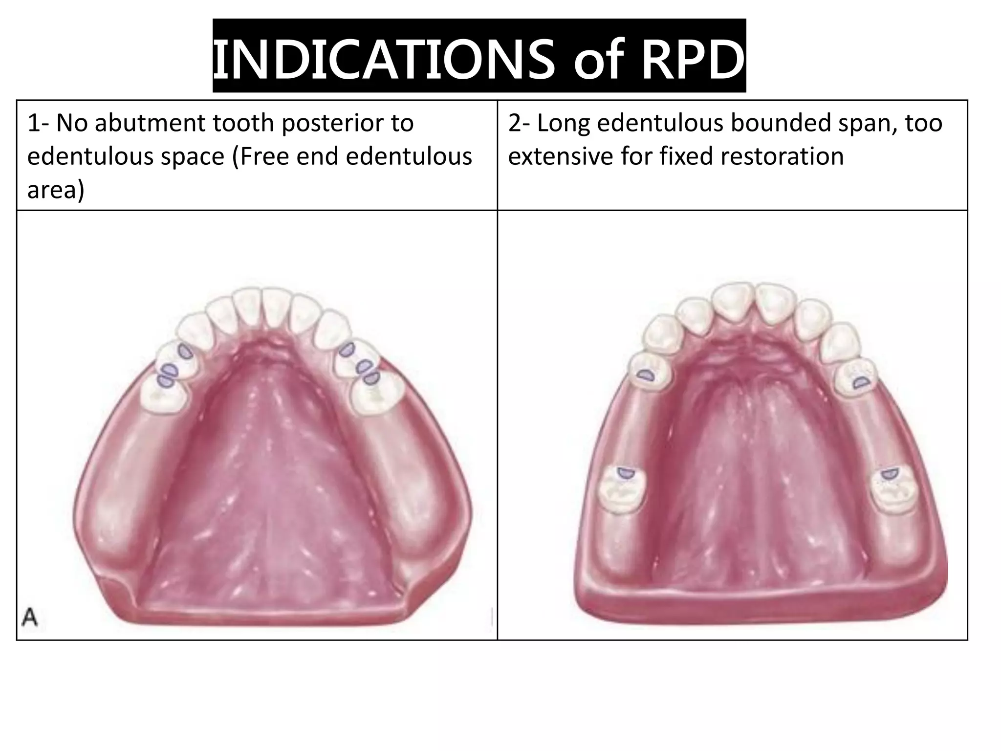 Removable Partial Denture 1. Introduction | PDF
