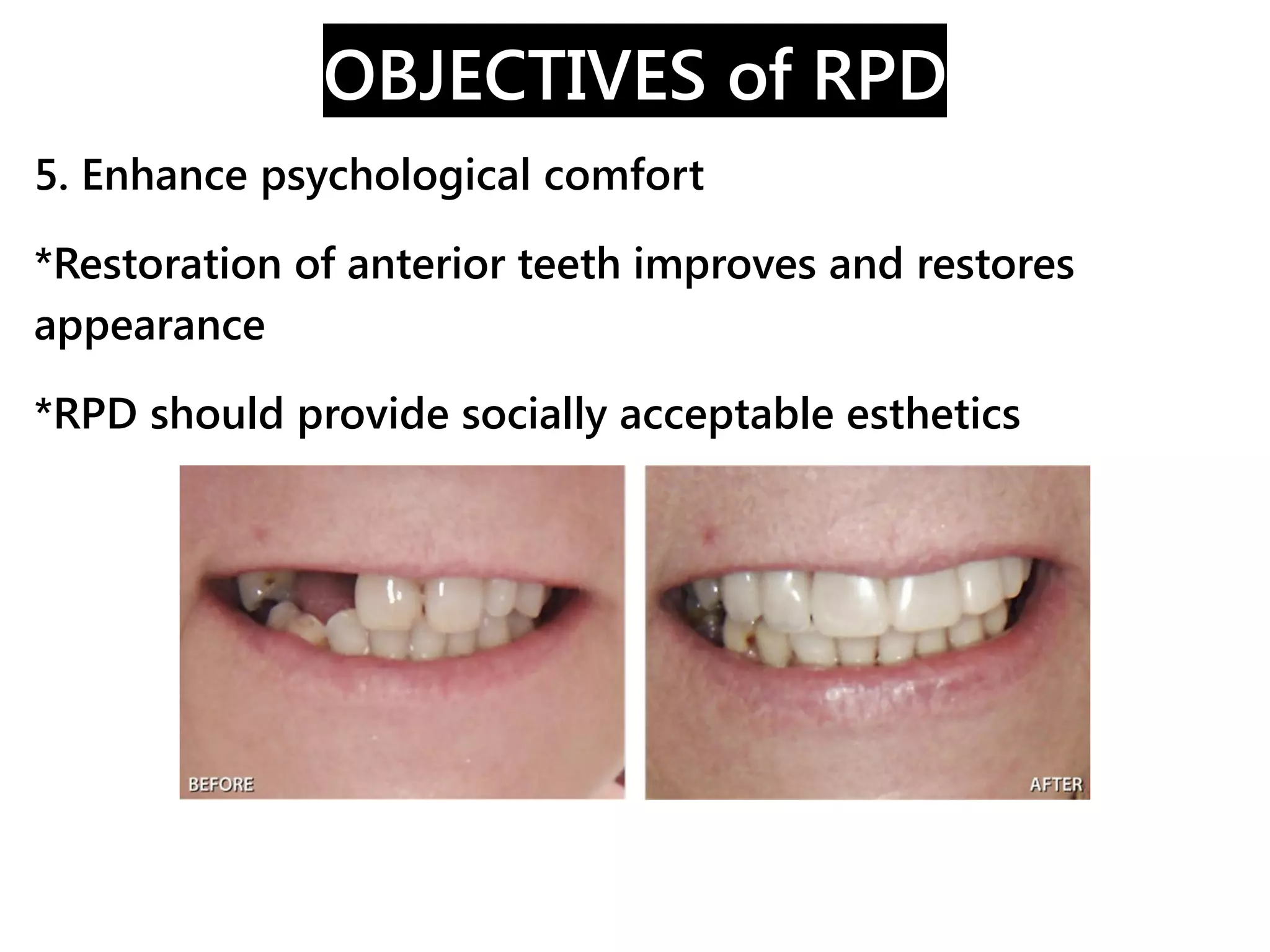 Removable Partial Denture 1. Introduction | PDF