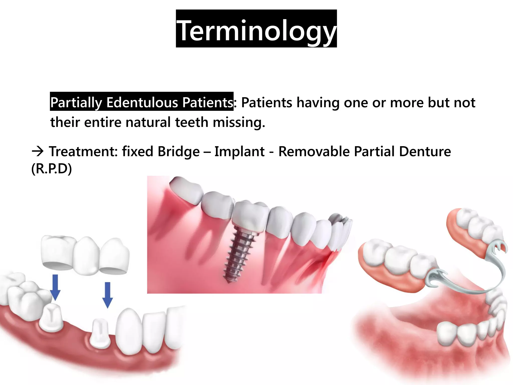 Removable Partial Denture 1. Introduction | PDF