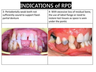 Removable Partial Denture 1. Introduction | PDF