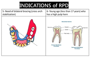 Removable Partial Denture 1. Introduction | PDF