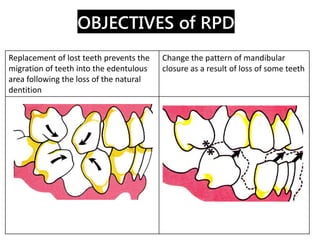 Removable Partial Denture 1. Introduction | PDF