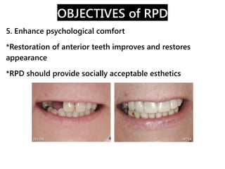 Removable Partial Denture 1. Introduction | PDF
