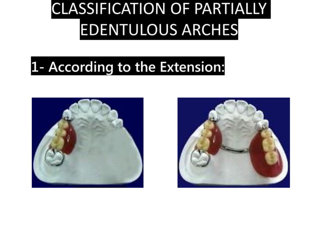 Removable Partial Denture 1. Introduction | PDF