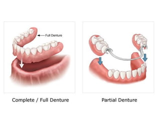 Removable Partial Denture 1. Introduction | PDF