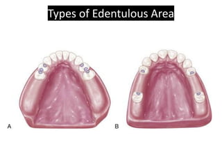 Removable Partial Denture 1. Introduction | PDF