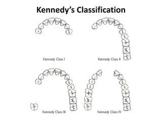 Removable Partial Denture 1. Introduction | PPT