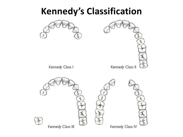 Removable Partial Denture 1. Introduction