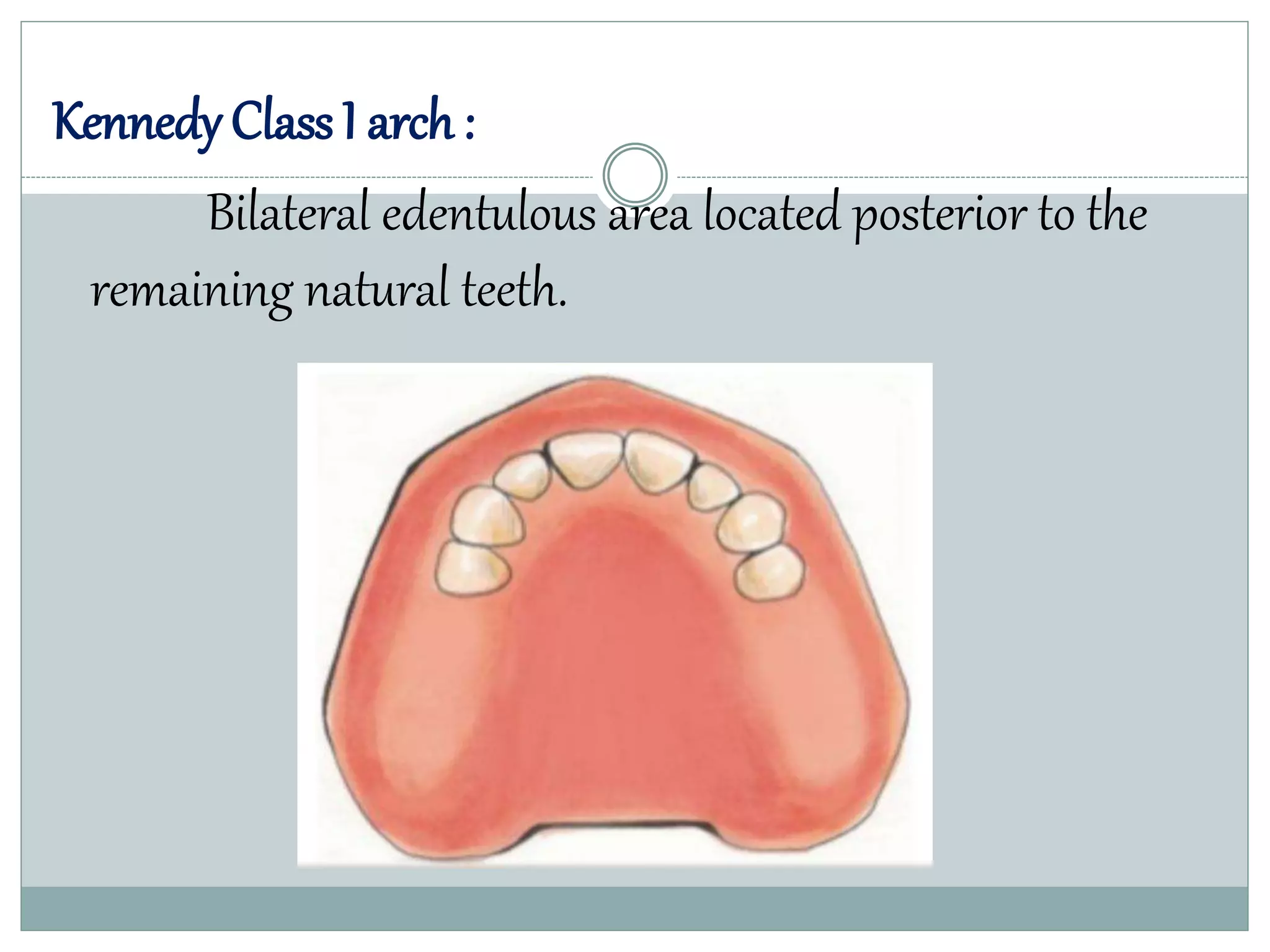 RPD BASICS.ppt