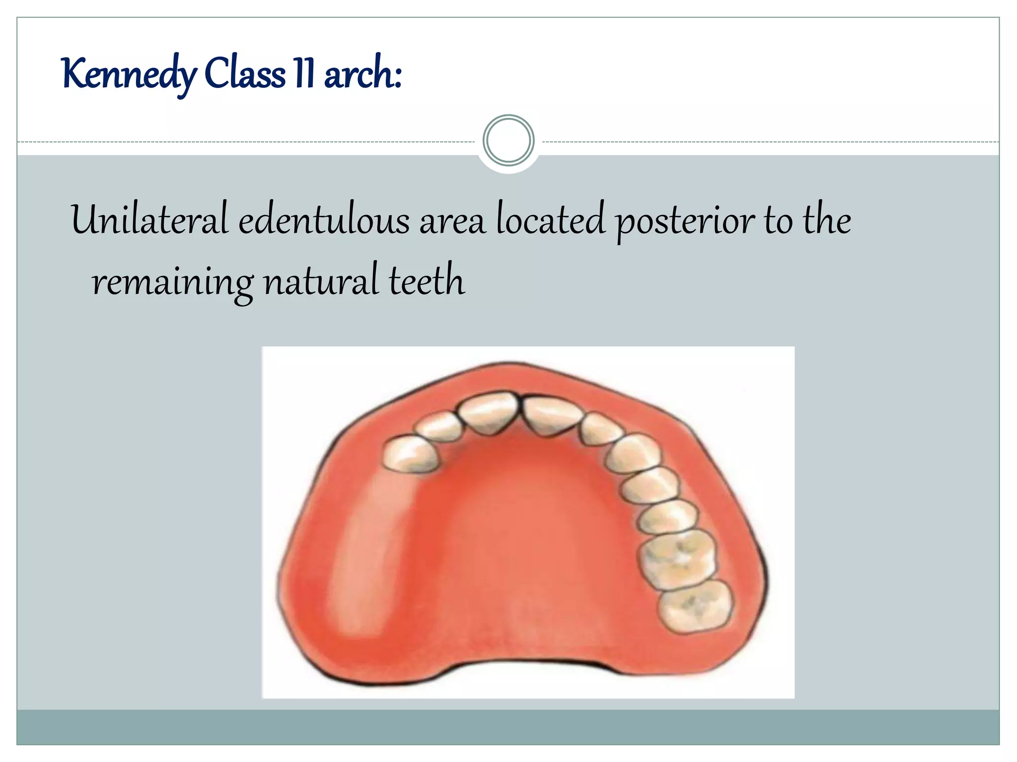 RPD BASICS.ppt