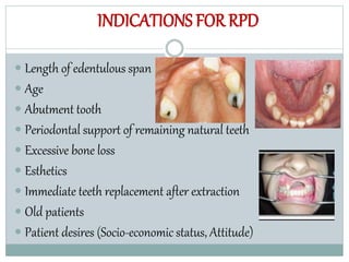 RPD BASICS.ppt