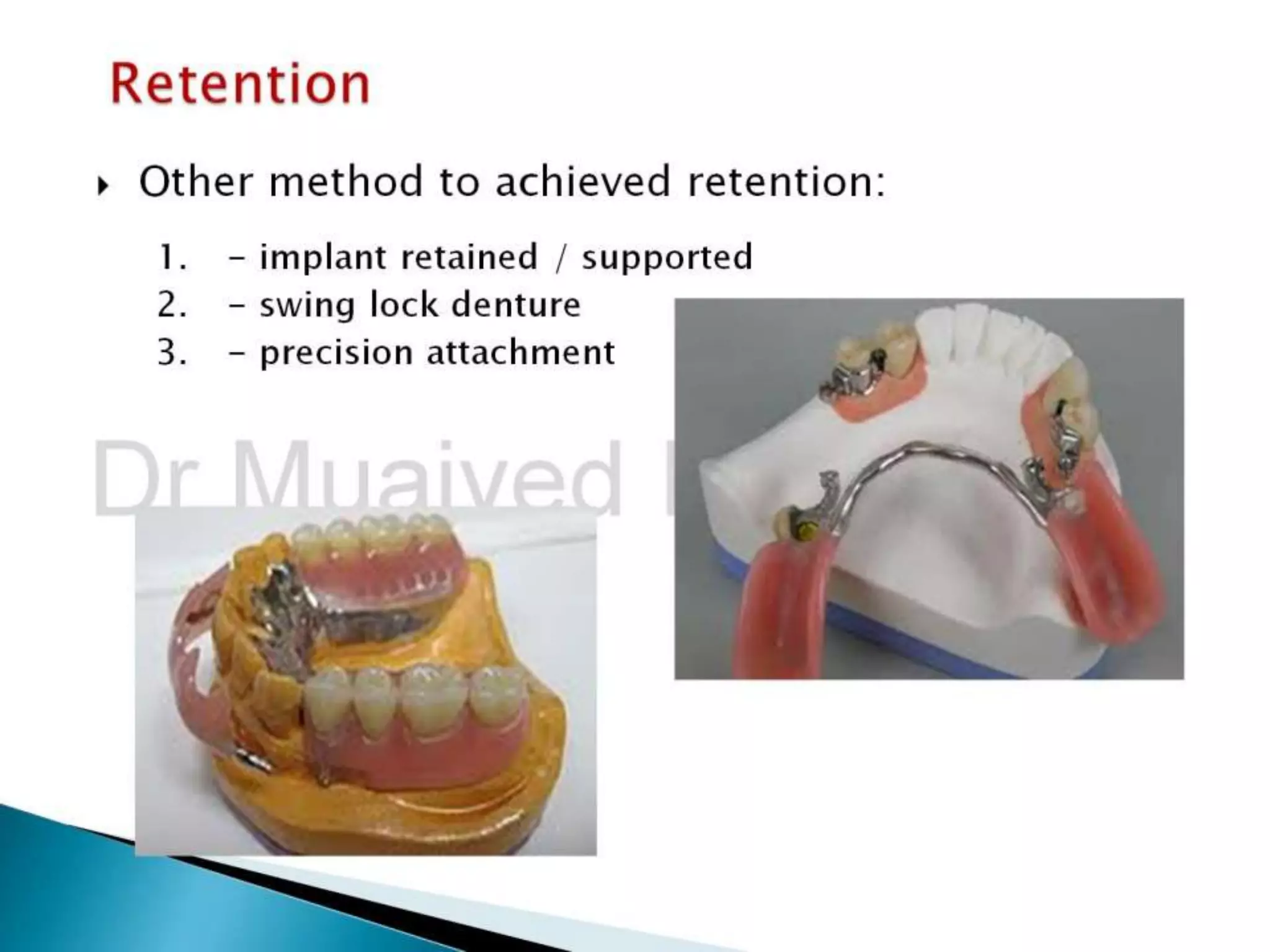 Rpd biomechanics principles of levers design consideration 4th year | PPT