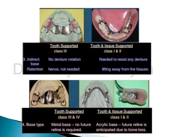 Rpd biomechanics principles of levers design consideration 4th year