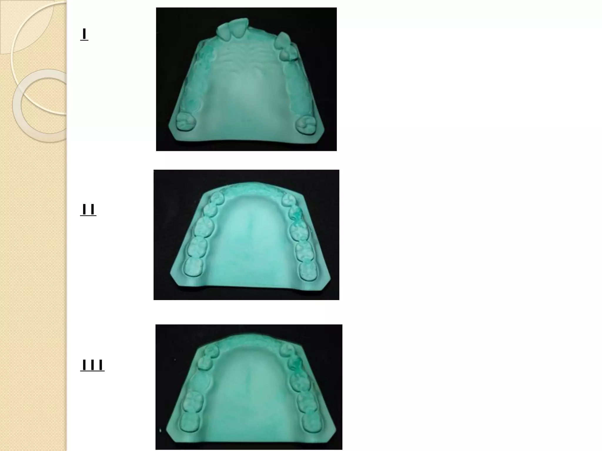 RPD Classification. | PDF