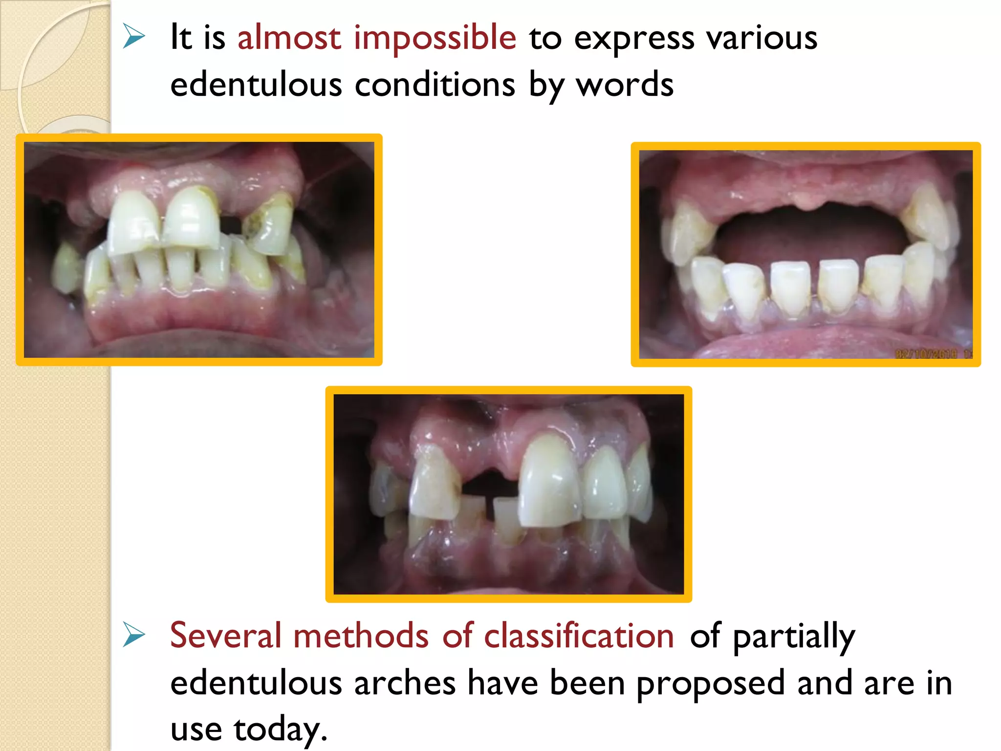 RPD Classification. | PDF
