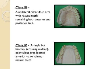 RPD Classification. | PDF