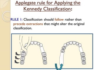 RPD Classification. | PDF