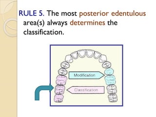 RPD Classification. | PDF