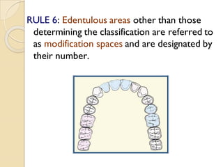 RPD Classification. | PDF