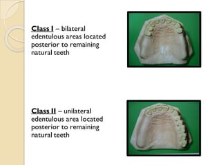 RPD Classification. | PDF
