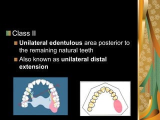 removable partial denture rpd classification.pdf